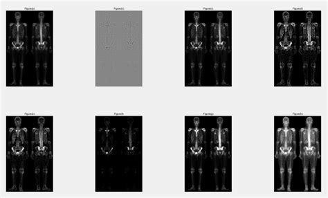 基于matlab数字图像处理之x射线图像的锐化和边缘检测滤波器 索炜达猿创