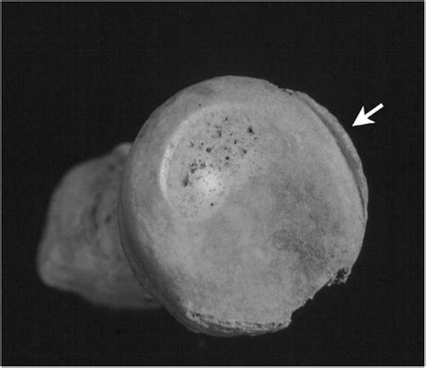 A Classification Of Bone Disease