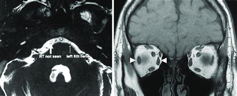 Axial Mr 3d Fiesta Image A Showing Expected Location Of Absent Download Scientific Diagram