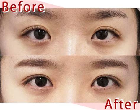 症例写真で医師が解説目を大きく華やかにできる目頭切開の効果をビフォーアフター写真で解説