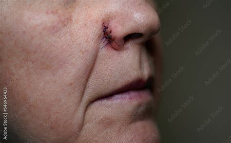 Woman With Human Papillomas Operated On The Nose Surgical Stitches