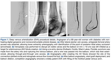 Jvir Access Percutaneous Deep Venous Arterialization In An Obl Setting