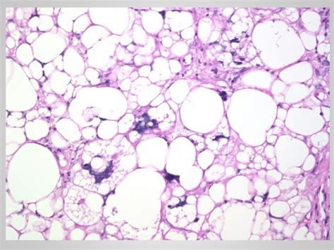 Soft Tissue Tumours Ppt