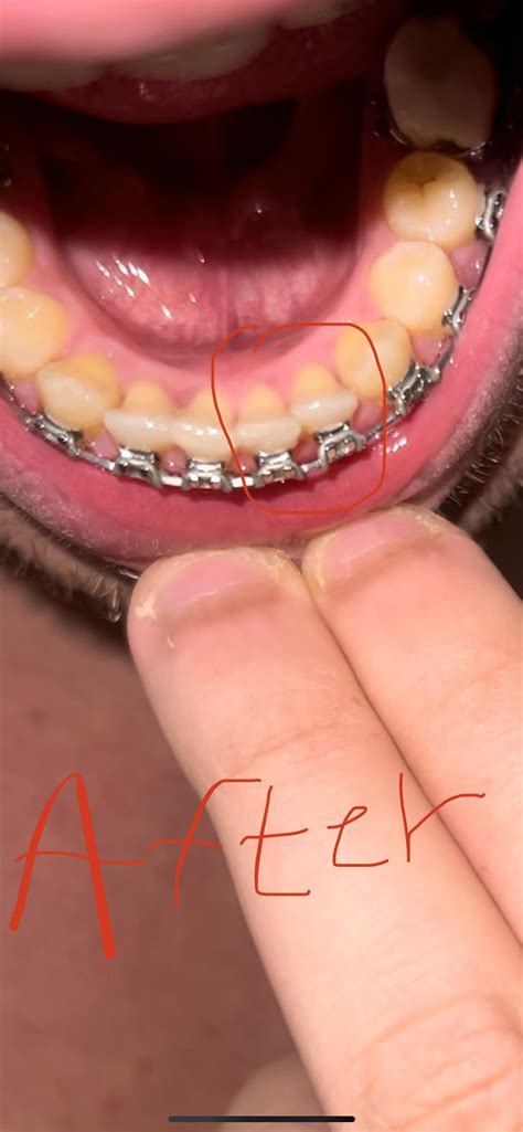 Overlapping Lower Teeth Even After Ipr Pictures Are Over A Month Apart Ortho Initially Did Ipr