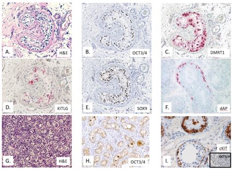 Predicting Gonadal Germ Cell Cancer In People With Disorders Of Sex
