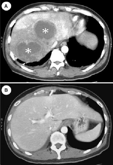 A Abdominal Ct Scan Shows A Multiloculated Abscess In The Right