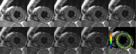 Mri With T2 Mapping Will Aid Myocardial Edema Diagnosis