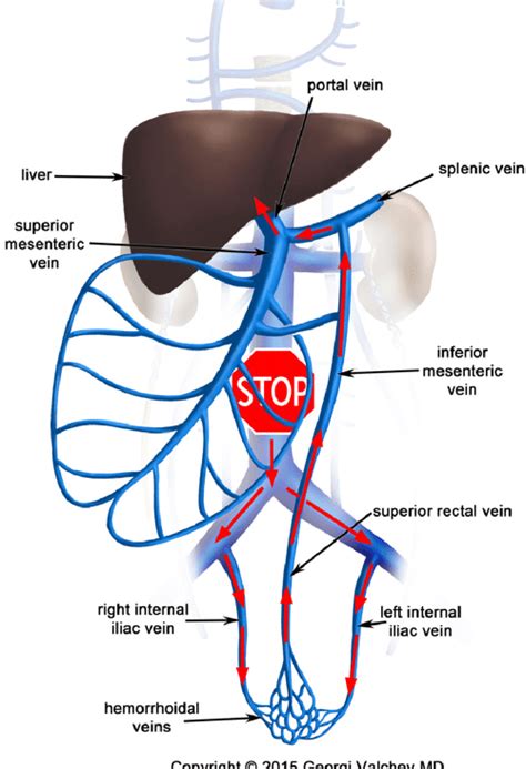 Figure 1 From Congenital Absence Of Inferior Vena Cava Semantic Scholar