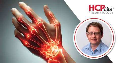 Whats Next For Dapirolizumab Pegol Following Lupus Phase 3 Trial With