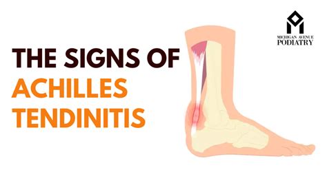 The Signs Of Achilles Tendinitis