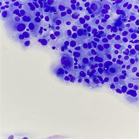Mediastinal Lymph Node Fna ~70yo M Rcytopathology