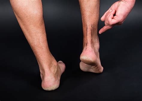 Strained Achilles Tendon Recovery Time Ogew
