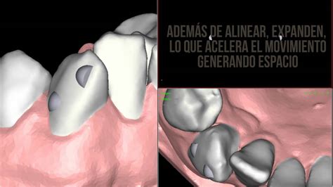 Irene La Especialista En Sonrisas Perfectas ORTODONCIA MODERNA