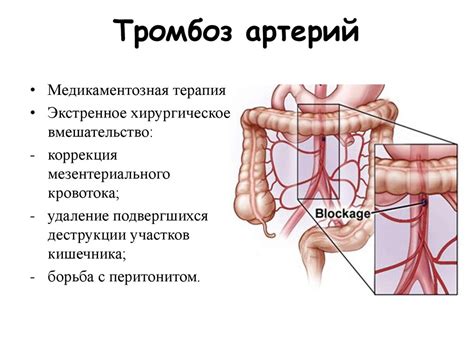 Хирургическое лечение тромбоза мезентеральных сосудов Online Presentation