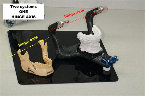 The Problem Of The Hinge Axis Concept The Problem Of The Hinge Axis Concept