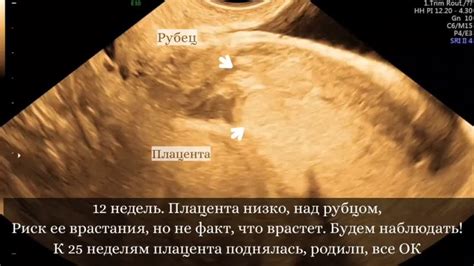 Нужно ли смотреть рубец на матке И да и нет Если нет жалоб и