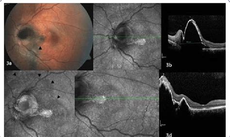 Features At Follow Up After Intravitreal Ranibizumab A Clinical