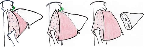 Schematic Representation Of Two Stage Hepatectomy With Preservation Of Download Scientific