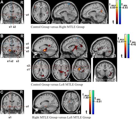 Functional Connectivity Maps Intergroup Comparisons Left Seed A Download Scientific