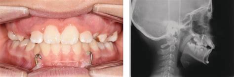Treatment For Class Iii Malocclusion Pocket Dentistry
