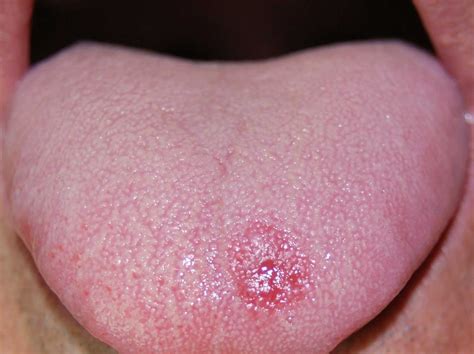 Il Lichen Sclerosus Vulvare Una Malattia Da Curare In Modo Precoce Latuapelle