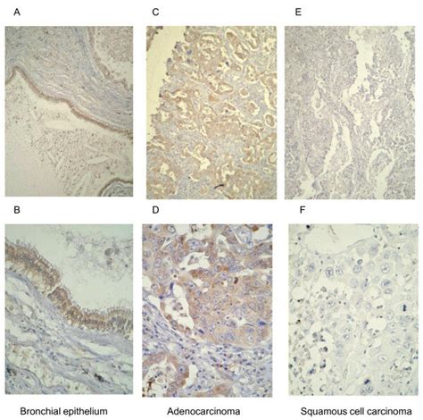 Immunohistochemical Staining Of Nmdar2b In Nsclc Tissue Nmdar2b