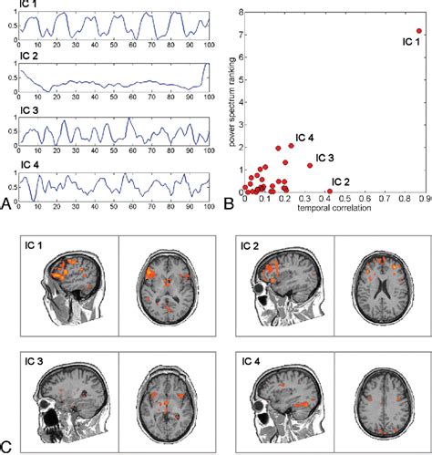 Figure 1 From With Brain Gliomas Functional Mr Imaging Analysis In Patients Hybrid Data