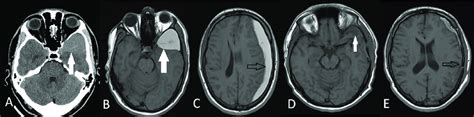 Preoperative Axial Ct A And Axial T1w Mri B Images Show Left Middle