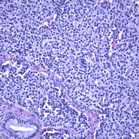 Nsulinoma With Solid Architecture And Rosettes Focally He Staining
