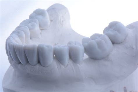 Injectable Composites Quick Fix Or Long Lasting Solution Dentistry