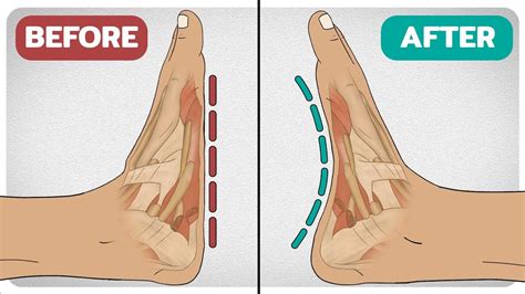 Exercises You Can Do At Home To Correct Knock Knees Artofit