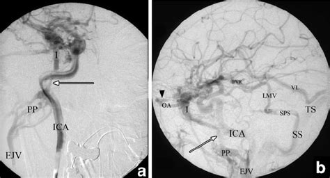 Dsa A Anteroposterior Projection Selective Injection Of The Right