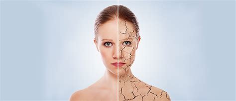 Understanding Ichthyosis Vulgaris Symptoms Causes And Treatment
