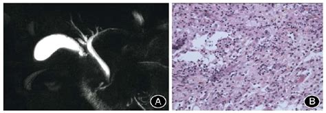 Lower Bile Duct Stenosis Caused By Xanthogranulomatous Chola Chinese Medical Journal