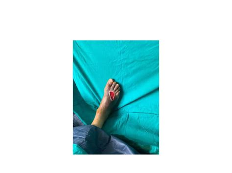 Diabetic Foot Dr Jitesh Jain Ppt