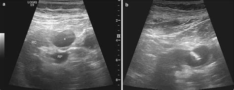 Renal Mass Biopsy Radiology Key