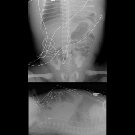 Newborn After Umbilical Arterial And Umbilical Venous Catheter