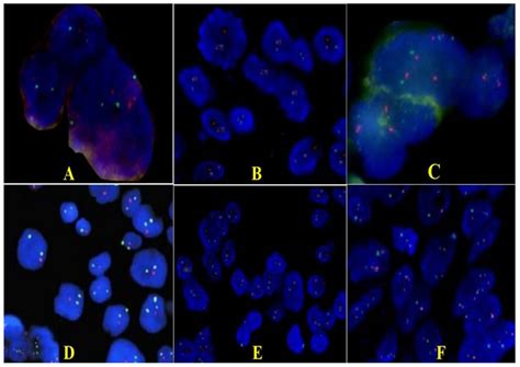 Representative Fish Results For P53 Ab Cdkn2a C P73 Gltscr1