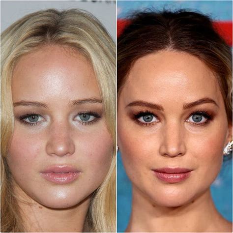 Eyelid Surgery Botox Injections Brow Lift Big Noses Mandy Moore