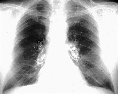 Image Silicosis—eggshell Calcifications Msd Manual Professional Edition