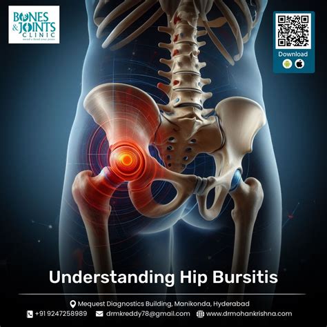 Beware Of Hip Bursitis At Bones And Joints Dr A Mohan Krishna Posted