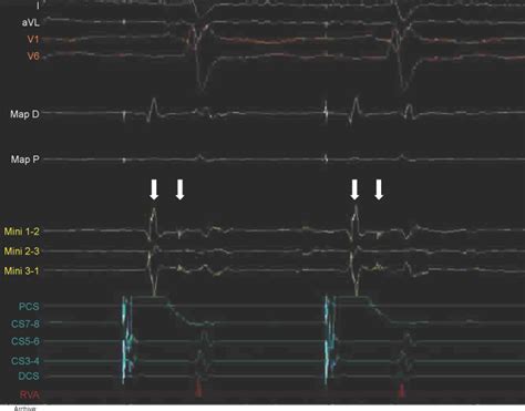 Verification Of Cavotricuspid Isthmus Block Using Electrical Download Scientific Diagram