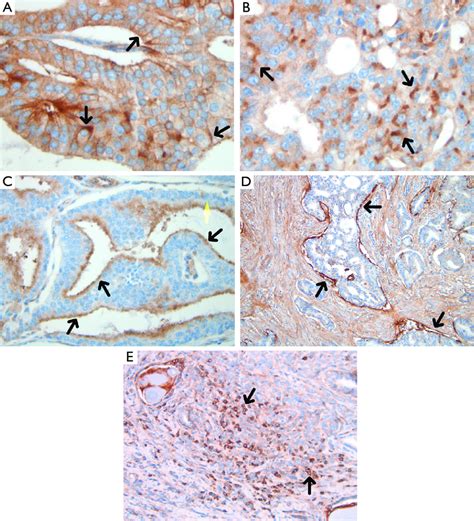 Malignant Prostatic Epithelium Showing Distinct Patterns Of αv