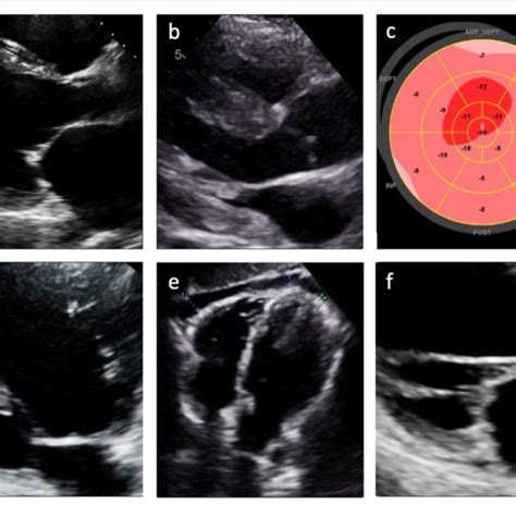 Echocardiographic Findings In Cardiac Sarcoidosis A Left Download Scientific Diagram