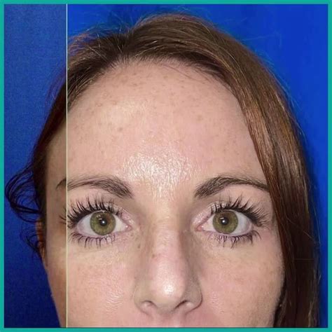 How To Rejuvenate Tired Eyes Under A Local Anesthesia Procedure Video Realself