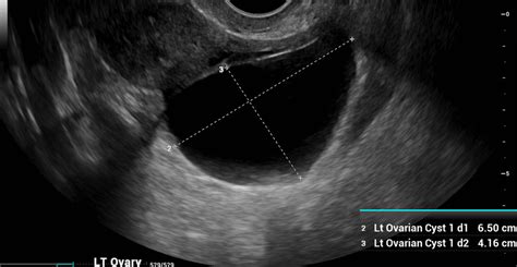 Courses Simple Ovarian Cysts Institute For Advanced Medical Education