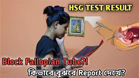 HSG Test Ar Report Hathey Pelam Fallopian Tube BlockedNa Open Kivhabe Bujhbe YouTube