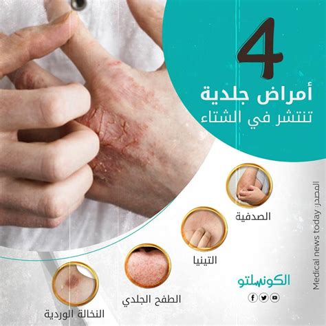 4 أمراض جلدية تنتشر في الشتاء إنفوجرافيك الكونسلتو