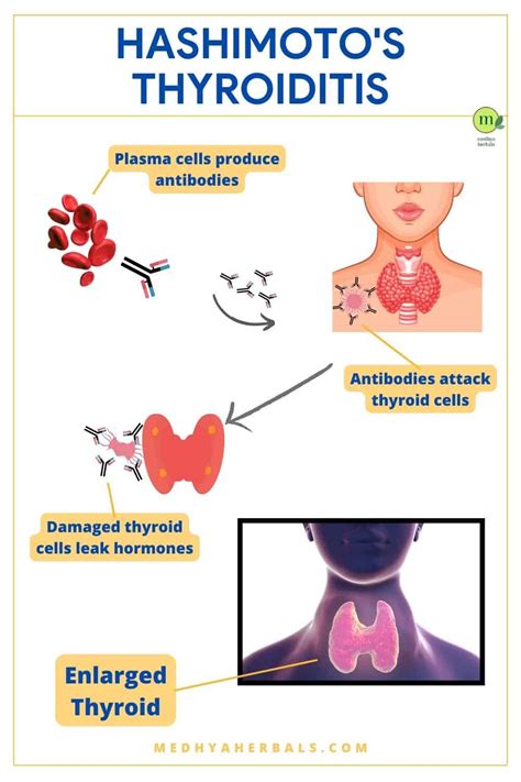 Hashimoto S Thyroiditis Ayurvedic Treatment Doctor S Guide