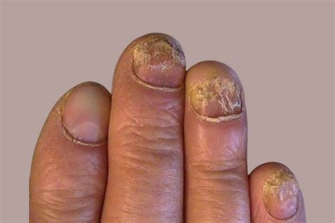 Những Cách Chữa Vẩy Nến Móng Tay Hiệu Quả Nhất Hiện Nay